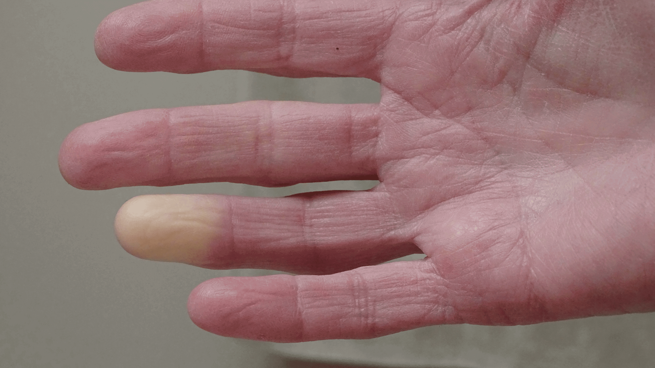 Fenômeno de Raynaud: o que é, diagnóstico e causas - Blog de Medcof ...