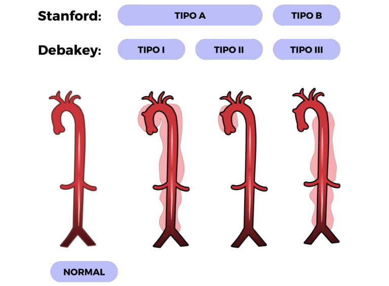 Classificação de Stanford e DeBakey para a Dissecção de Aorta - Blog de ...