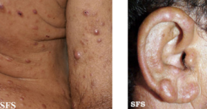 Formas clínicas da hanseníase - Blog de Medcof: conteúdos, editais ...