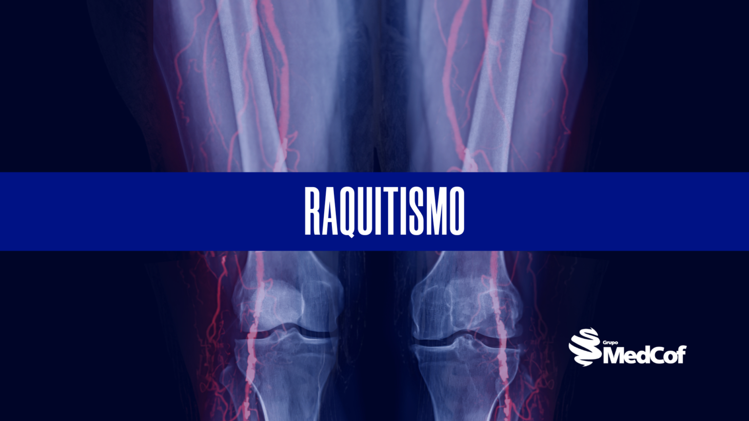 Raquitismo: Definição e Fatores de risco. - Blog de Medcof: conteúdos ...