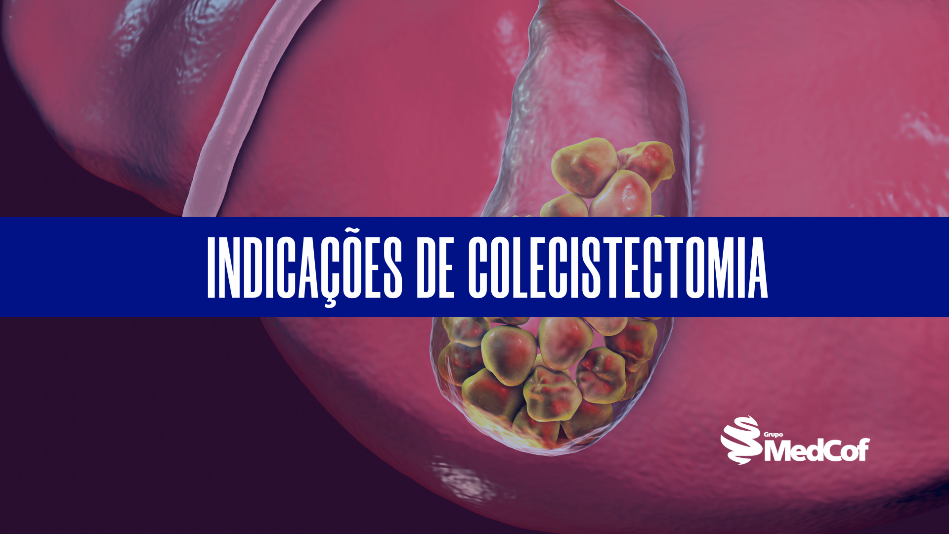 Conheça as indicações de colecistectomia e não erre mais! - Blog de ...
