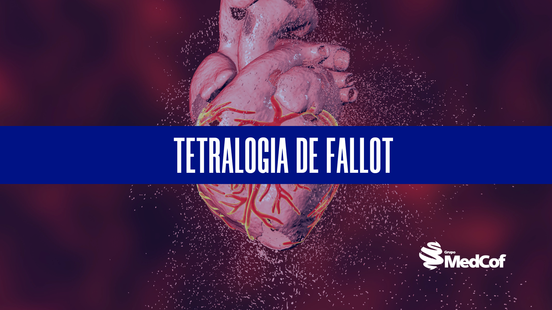 Tetralogia de Fallot: Definição, fisiopatologia, exame físico e mais ...