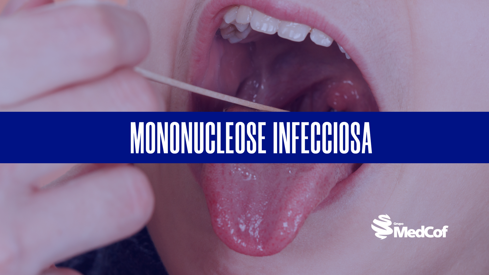 Mononucleose infecciosa - Blog de Medcof: conteúdos, editais, revalida ...