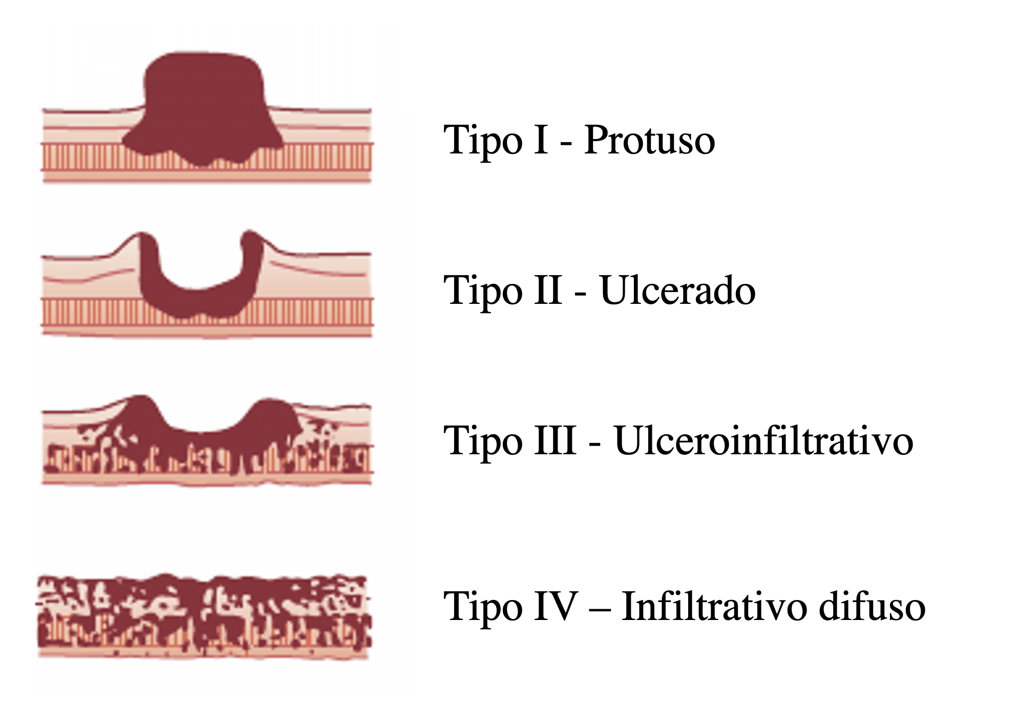 Câncer gástrico: como classificar? - Blog de Medcof: conteúdos, editais ...