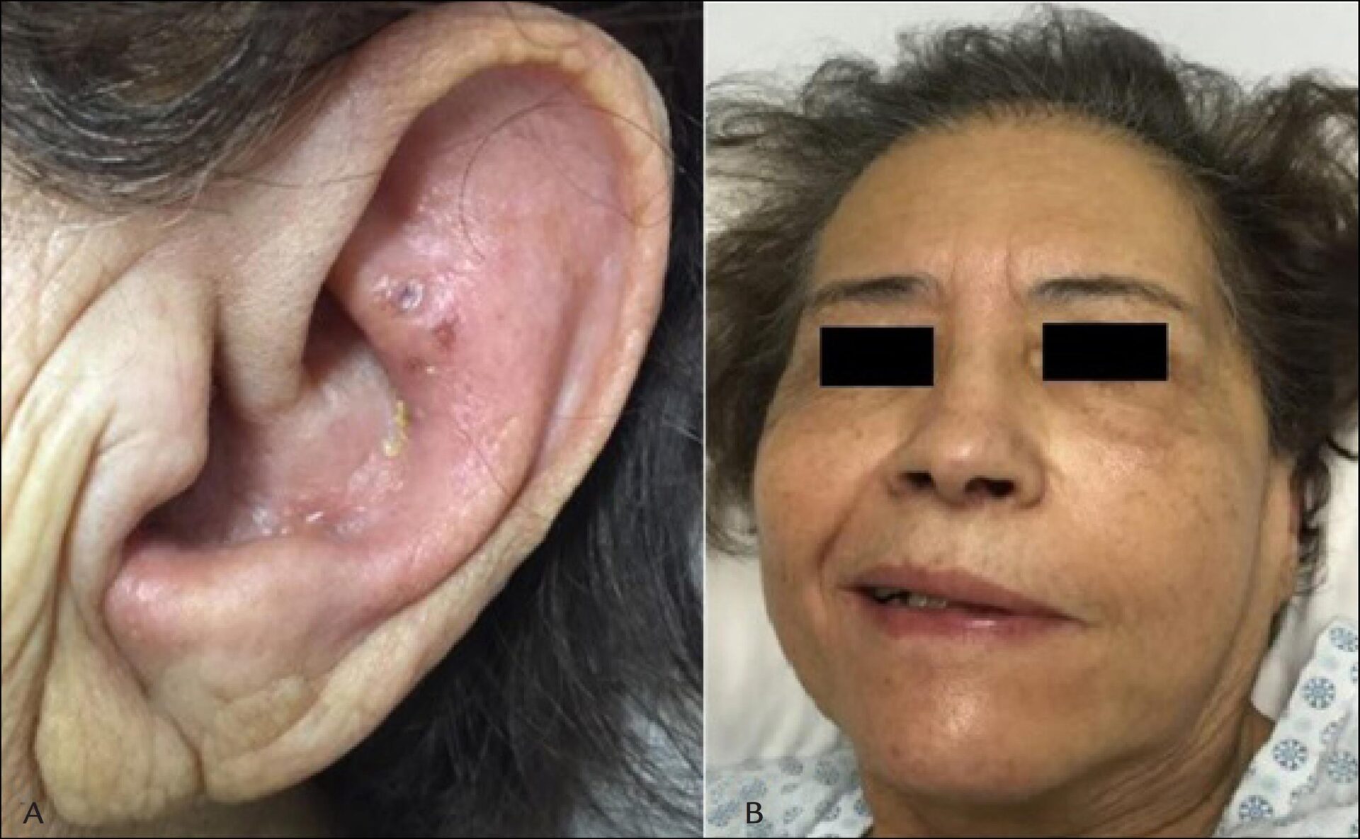 Herpes-Zóster: O que é? - Blog de Medcof: conteúdos, editais, revalida ...