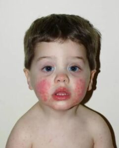 Identificando as diferentes doenças exantemáticas - Blog de Medcof ...